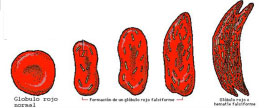 ANEMIA DREPANOCÍTICA O ENFERMEDAD DE LAS CÉLULAS FALCIFORMES – Infogen