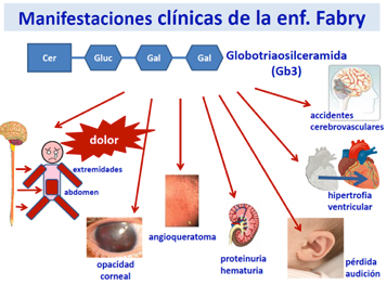 Enfermedad de Fabry – Infogen
