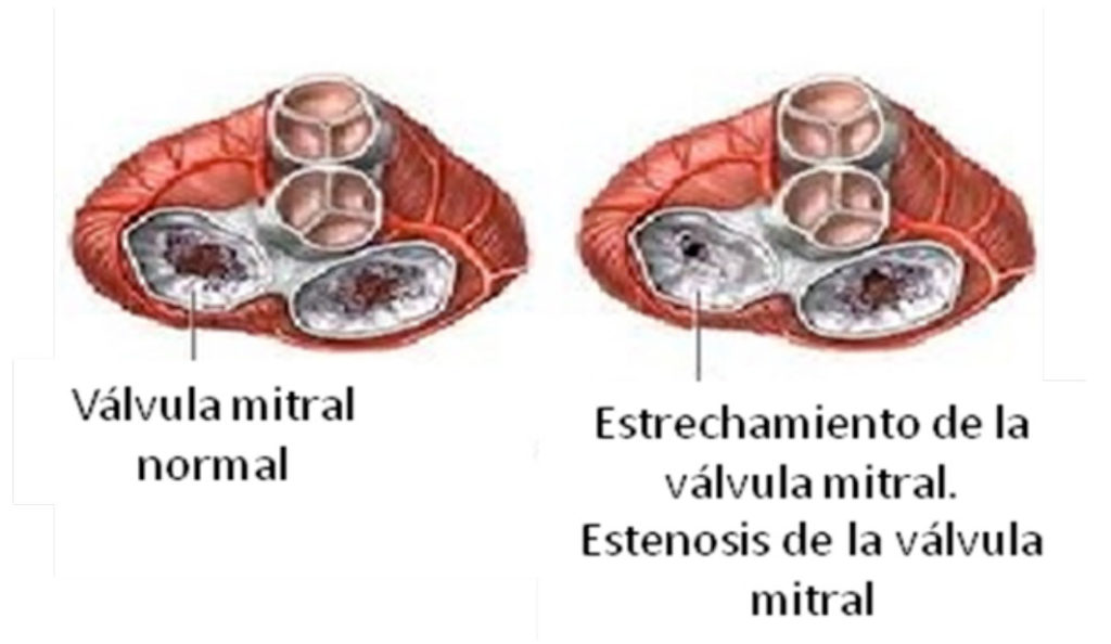 Cardiopatías y embarazo, enfermedades del corazón y el embarazo – Infogen