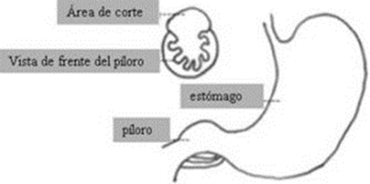 Estenosis pilórica – Infogen