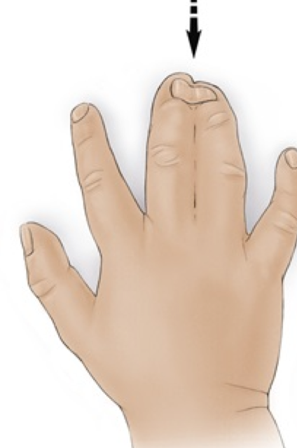 Sindactilia – Infogen