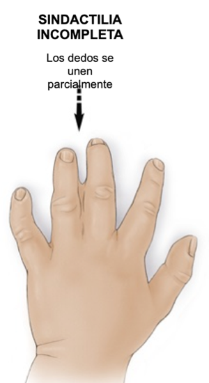 Sindactilia – Infogen